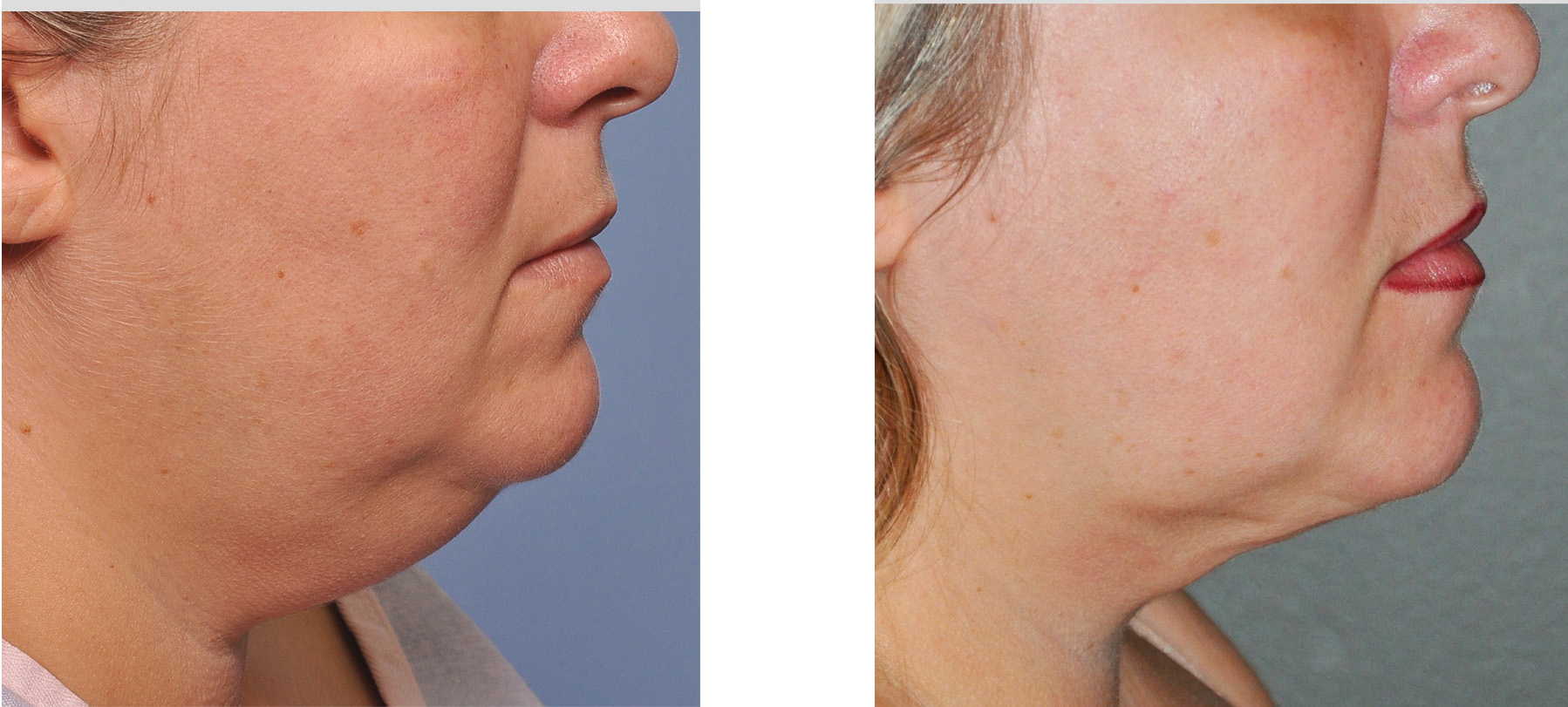 Recovery after Neck Liposuction - Explore Plastic Surgery
