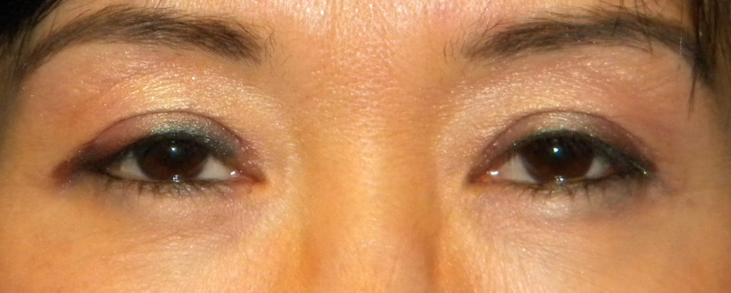 Corner of the Eye Tuck-ups - Lateral Canthoplasty and Lateral ...