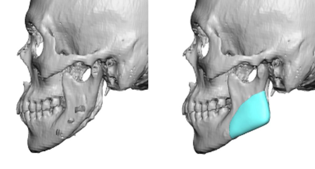 Custom Jaw Angle Implants for Jaw Angle Restoration left side Dr Barry ...