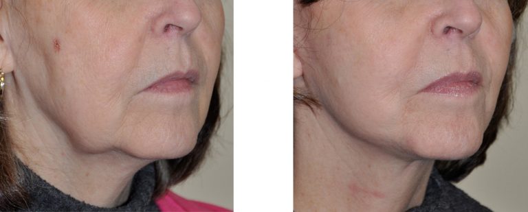 The Jawline Lift - A 3/4 Facelift - Explore Plastic Surgery