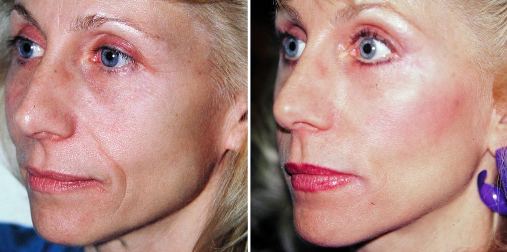 Midface Lift Rejuvenation Techniques - Explore Plastic Surgery