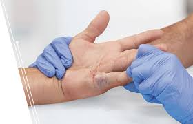 Xiaflex Injections for Duputryen's Finger Contractures - Explore ...