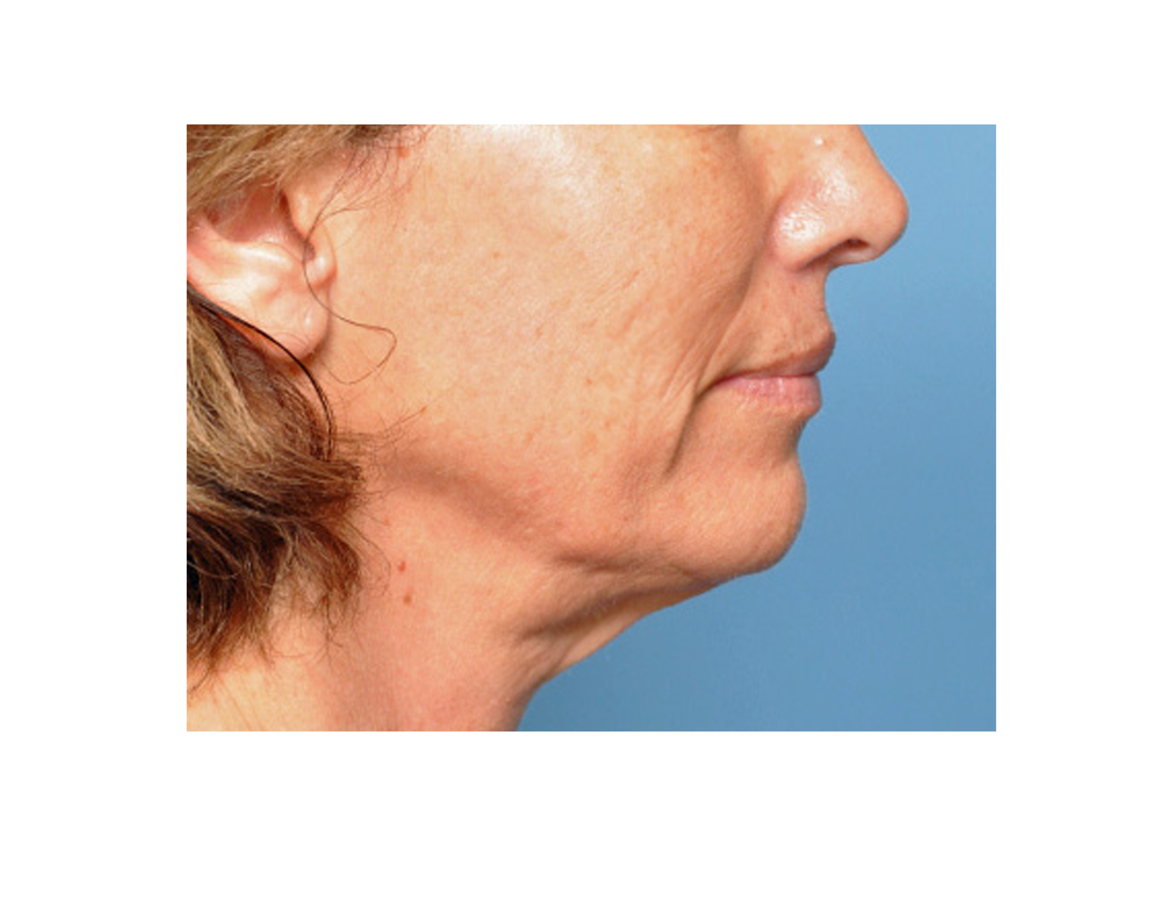 early-neck-sagging-dr-barry-eppley-indianapolis - Explore Plastic Surgery