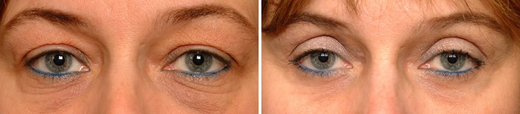 Getting Rid Of Lower Eyelid Bags with Blepharoplasty Surgery - Explore ...