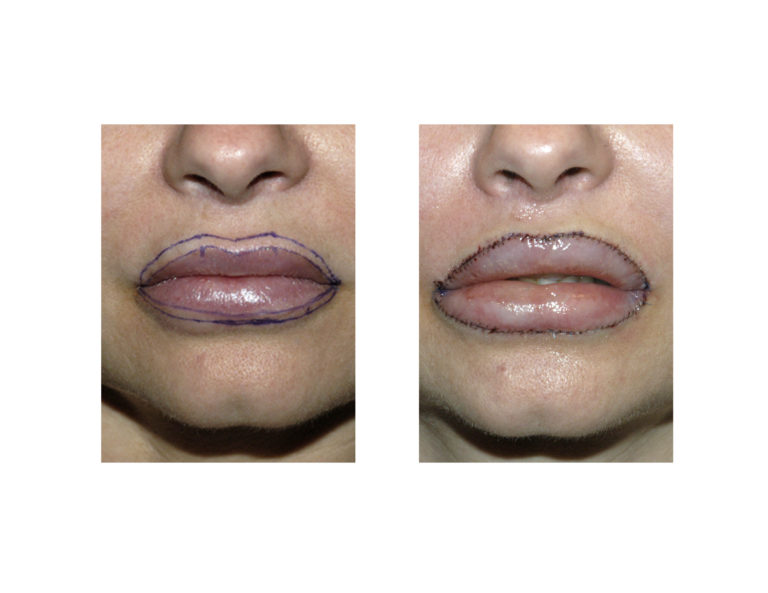Case Study: Upper and Lower Lip Vermilion Advancements for Injectable ...