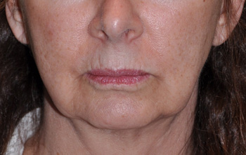 sagging-jowl-surgery-dr-barry-eppley-indianapolis - Explore Plastic Surgery