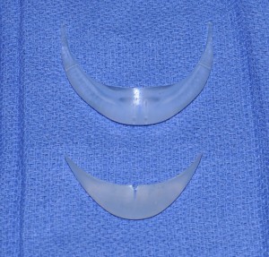 extended-chin-implant-replacing-smaller-chin-implant-dr-barry-eppley ...