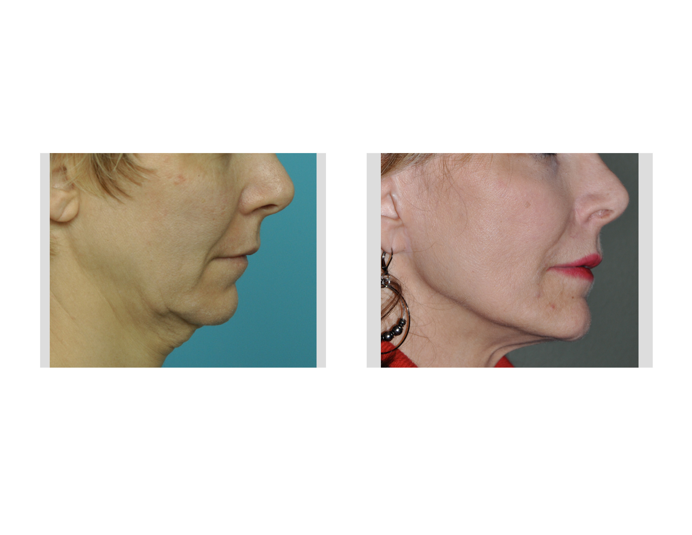 facial-skeletal-augmentation-in-facelift-dr-barry-eppley-indianapolis ...