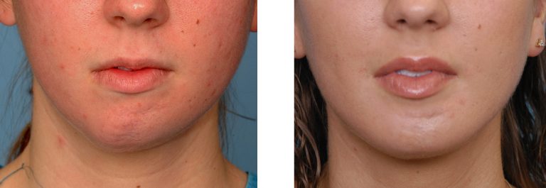 Understanding Male vs Female Shapes in Chin Augmentation Surgery ...