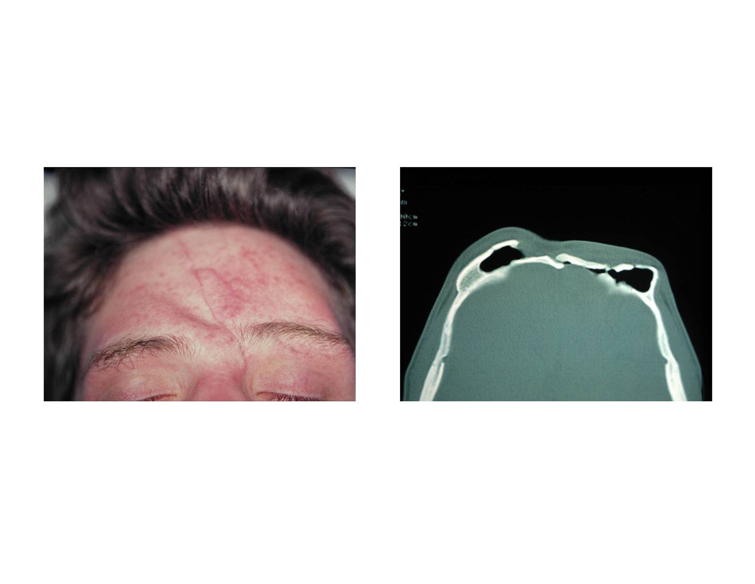 frontal-contour-defect-dr-barry-eppley - Explore Plastic Surgery