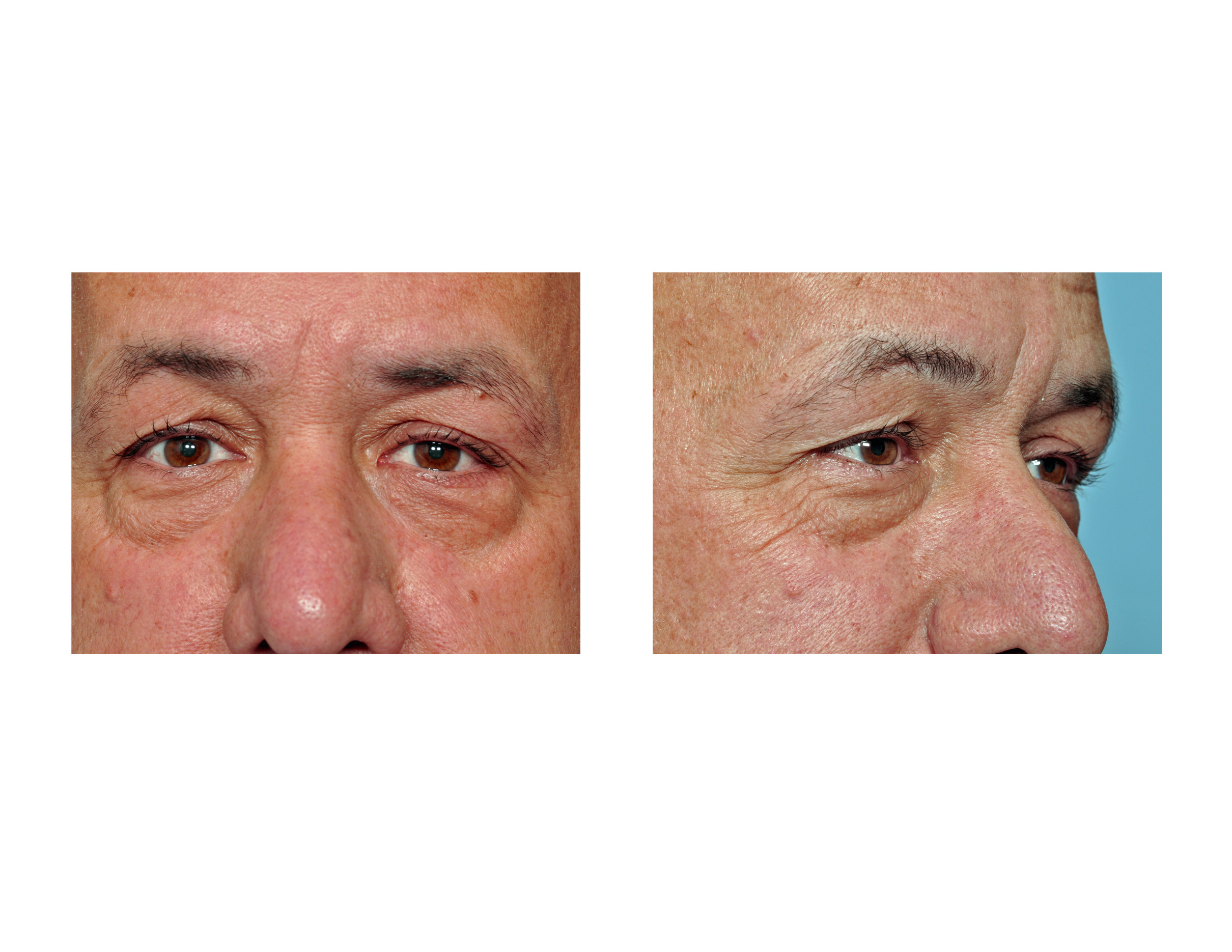 aging-eyes-in-men-dr-barry-eppley-indianapolis - Explore Plastic Surgery
