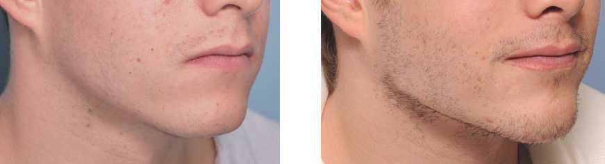 Options in Aesthetic Jawline Enhancement - Explore Plastic Surgery