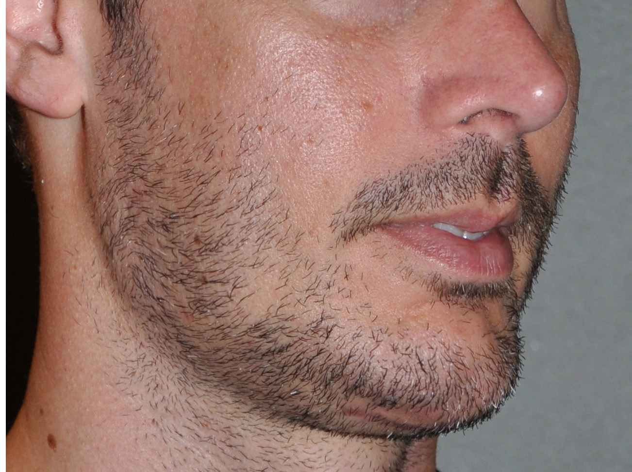 male vertical lengthe ing jaw angle implants oblique after dr barry ...