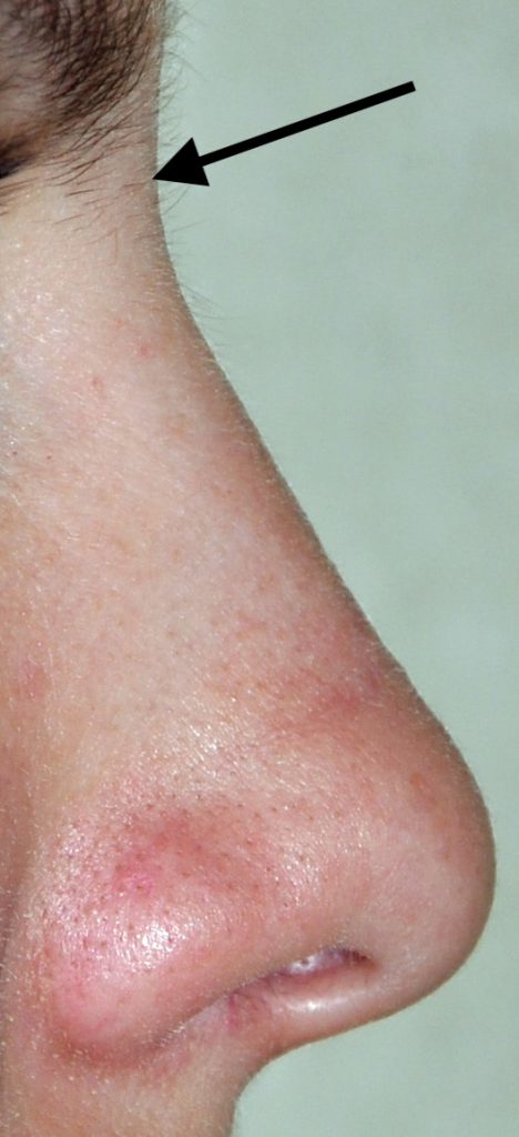 radix in rhinoplasty dr barry eppley indianapolis - Explore Plastic Surgery