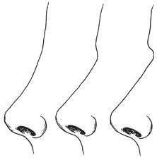 radix-in-rhinoplasty - Explore Plastic Surgery