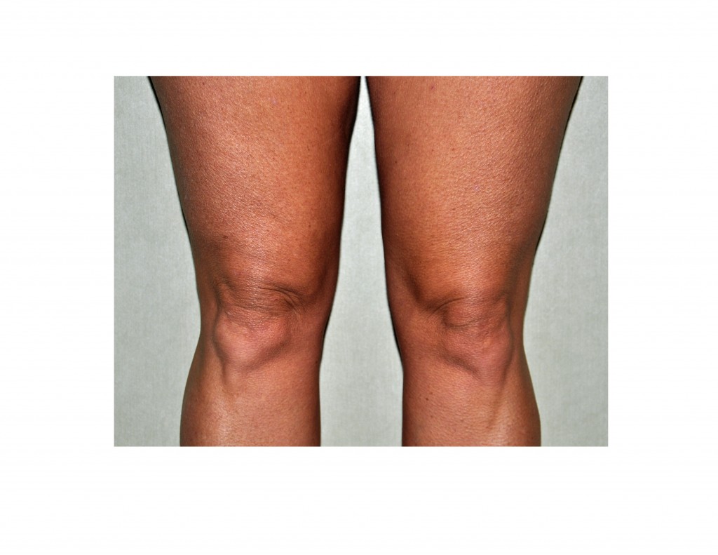 Case Study: Liposuction of the Knees - Explore Plastic Surgery