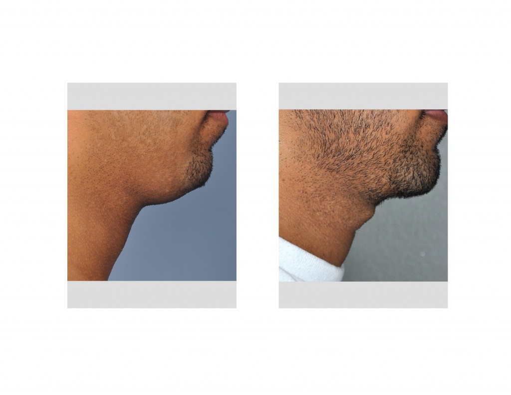 Options in Neck Contouring - 2. Hard Tissue Procedures - Explore ...