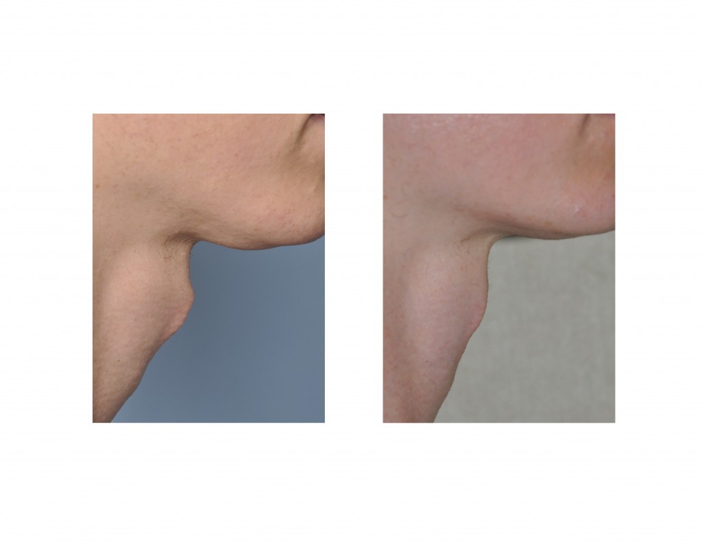 Options in Neck Contouring - 2. Hard Tissue Procedures - Explore ...
