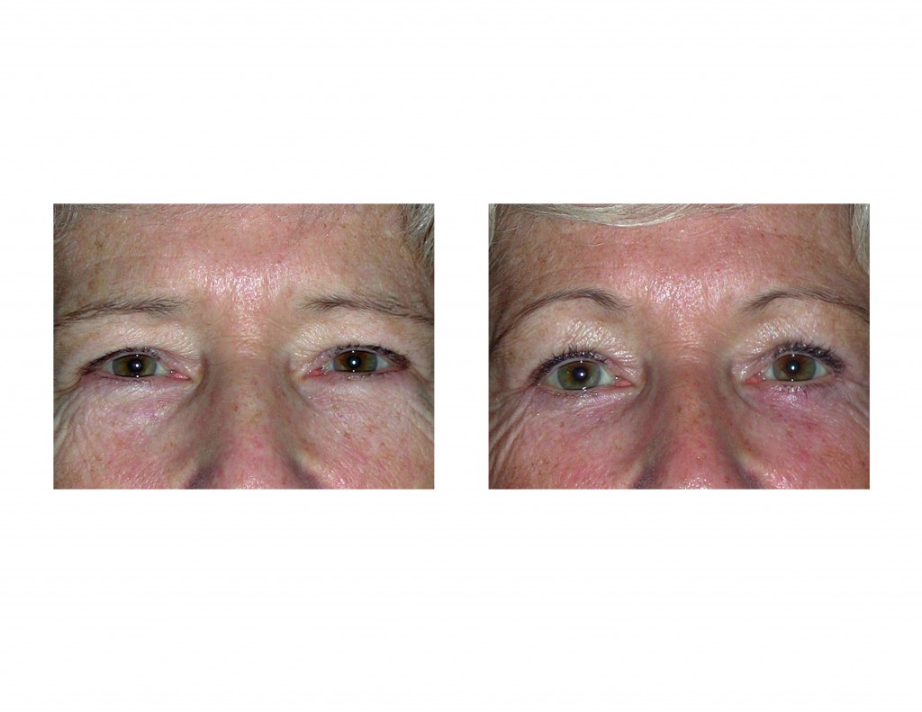 Endoscopic Browlift Indianapolis Dr Barry Eppley - Explore Plastic Surgery