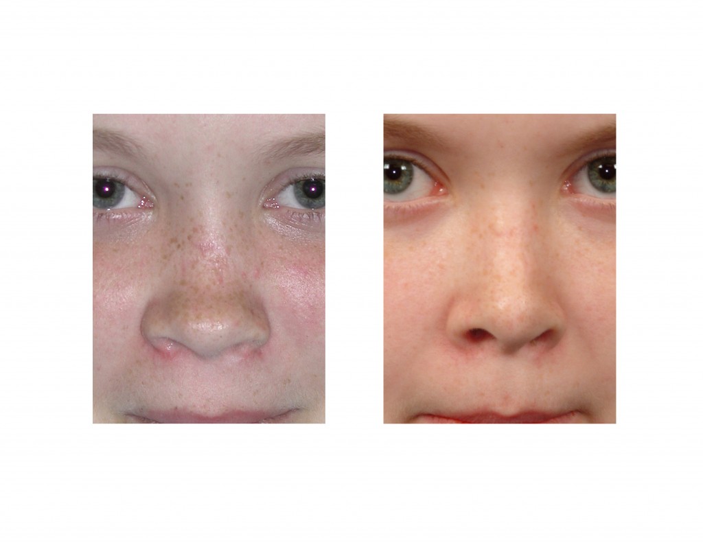Case Study: Rib Grafting for the Saddle Nose Deformity - Explore ...