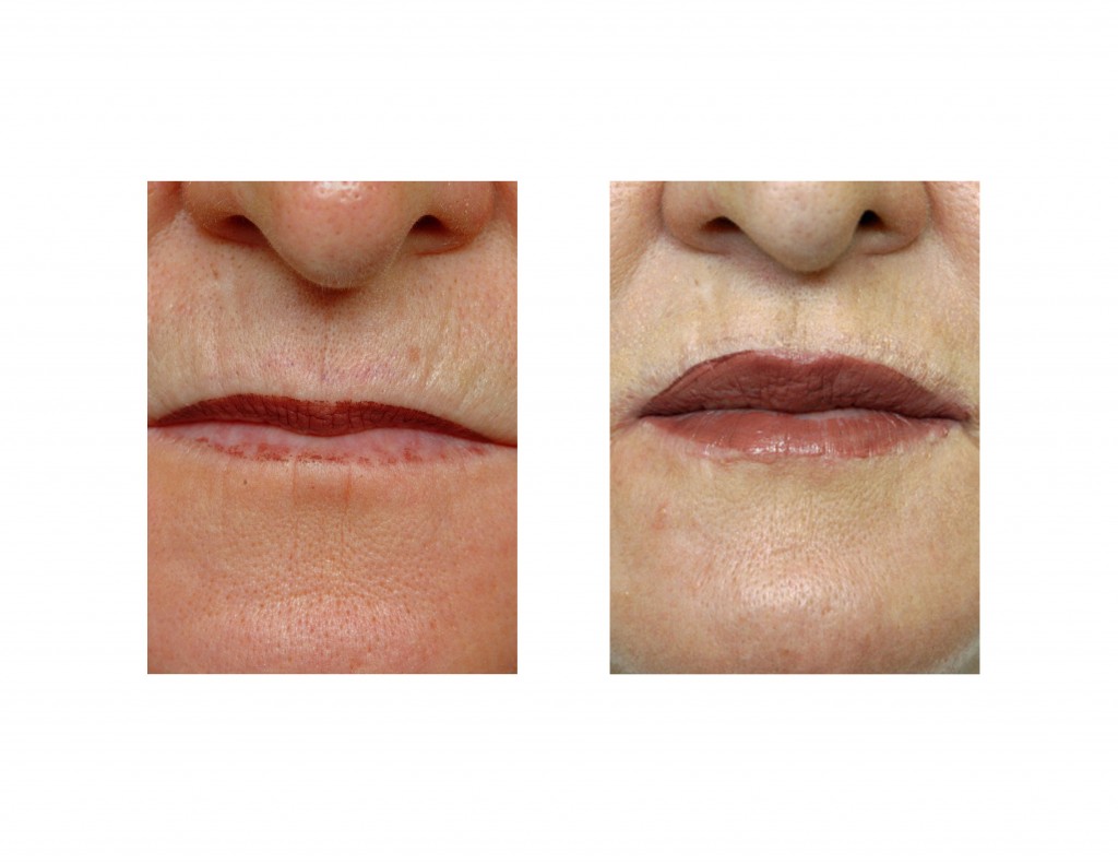 The Role Of Excisional Lifts in Lip Enhancement - Explore Plastic Surgery