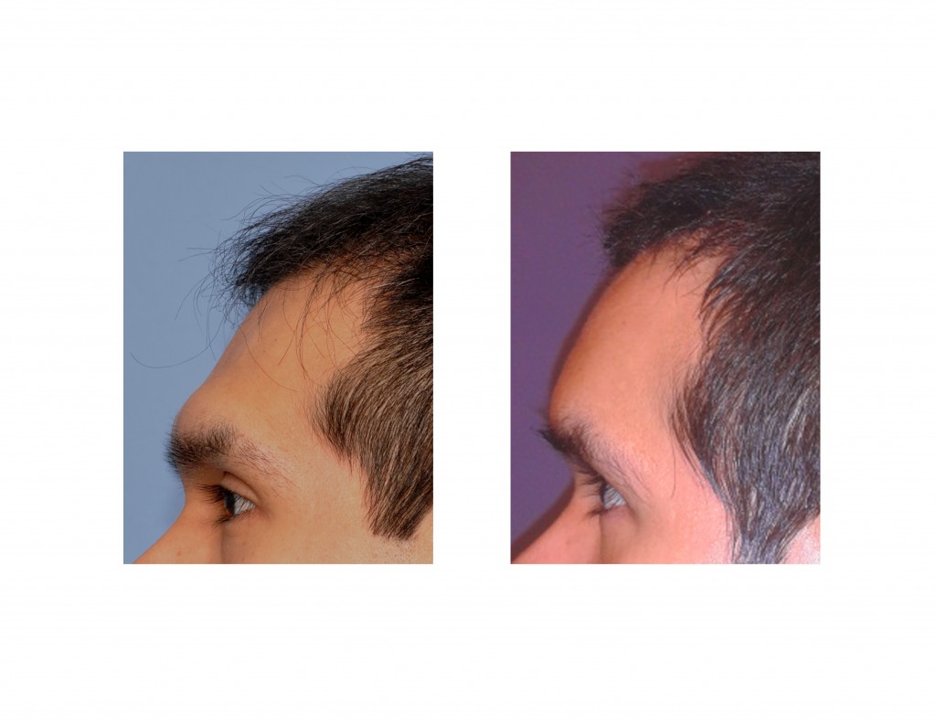 Forehead Augmentation in Men - Explore Plastic Surgery