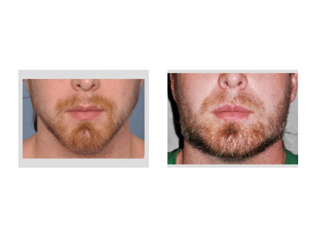 Contemporary Implant Concepts For Surgical Jawline Enhancement ...