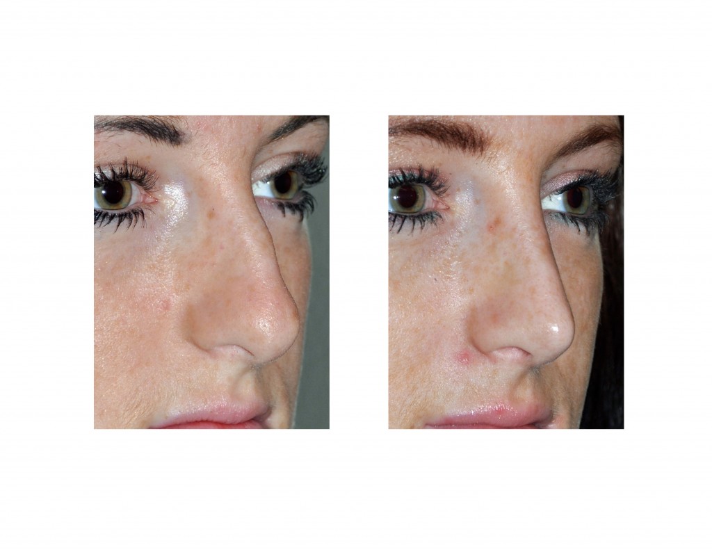 Fat Nose Rhinoplasty result oblique view - Explore Plastic Surgery