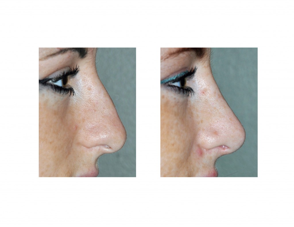 Case Study: Rhinoplasty For Slimming The Wide Nose - Explore Plastic ...