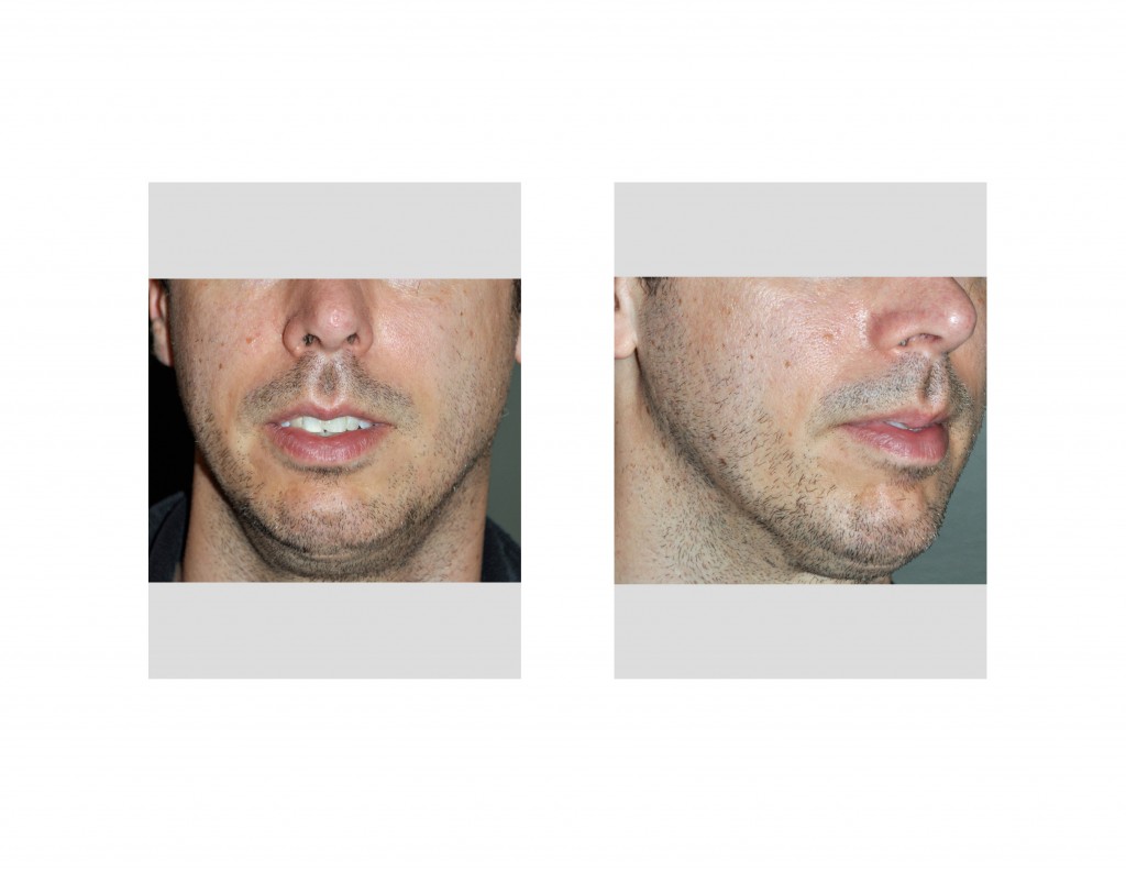 Case Study: Jawline Enhancement in the Thin Male Face - Explore Plastic ...