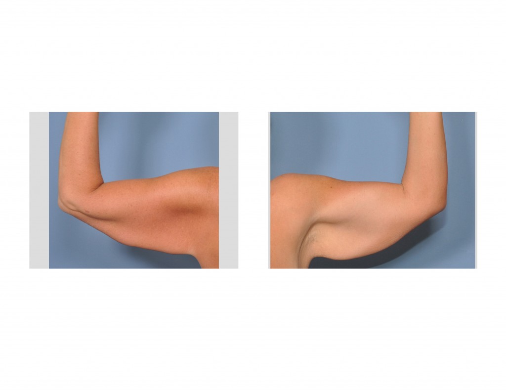 Case Study: Long-Term Scar Outcome From Arm Lifts - Explore Plastic Surgery
