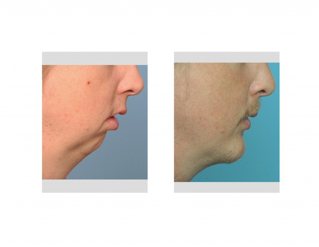 Case Study: Extreme Chin Augmentation with Combined Osteotomy and ...