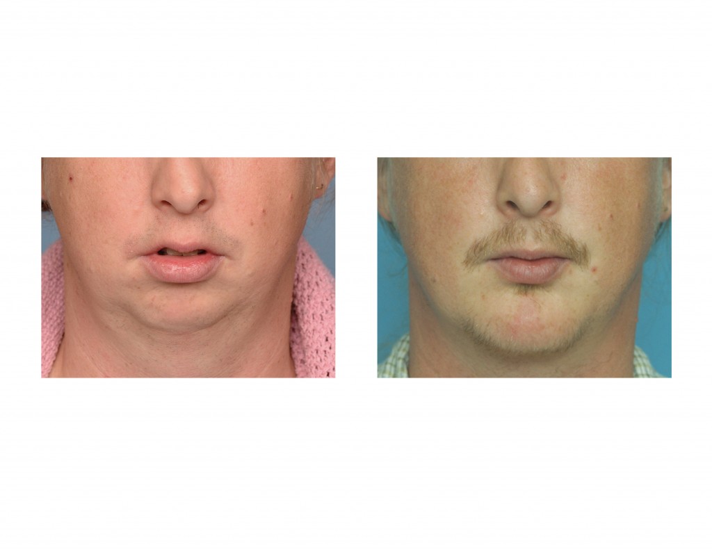 Case Study: Extreme Chin Augmentation with Combined Osteotomy and ...