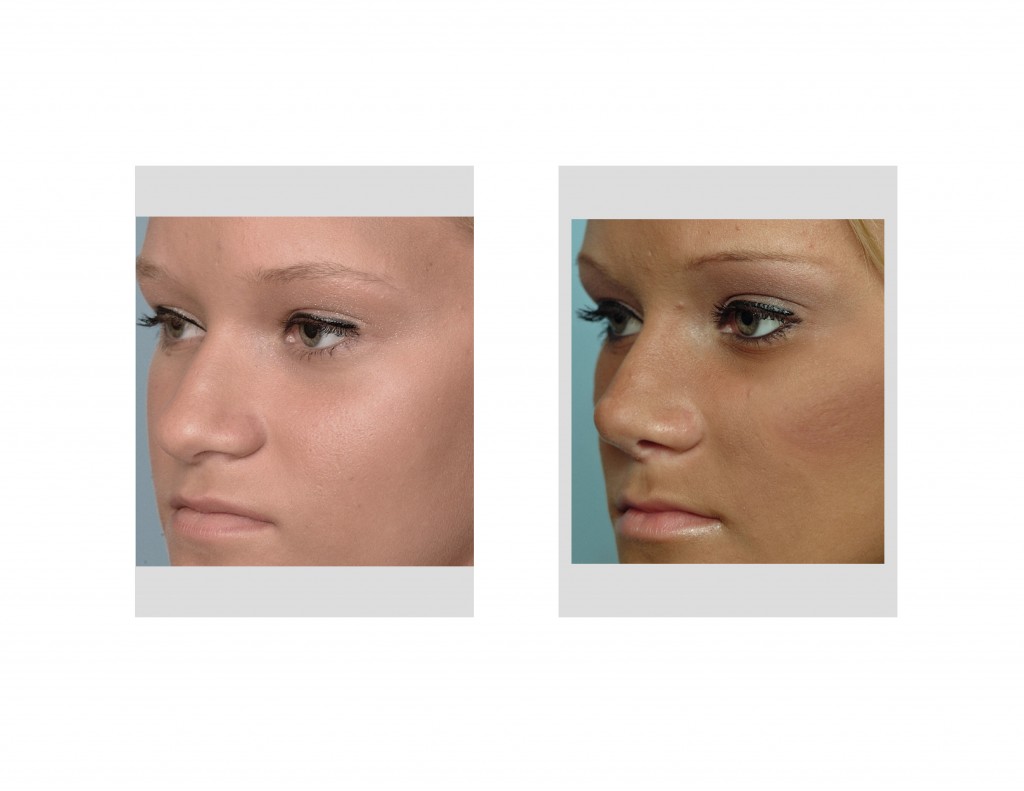 Female Cheek Implants Dr Barry Eppley Indianapolis - Explore Plastic ...