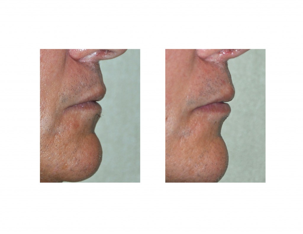Case Study: Male Lip Implant Augmentation - Explore Plastic Surgery