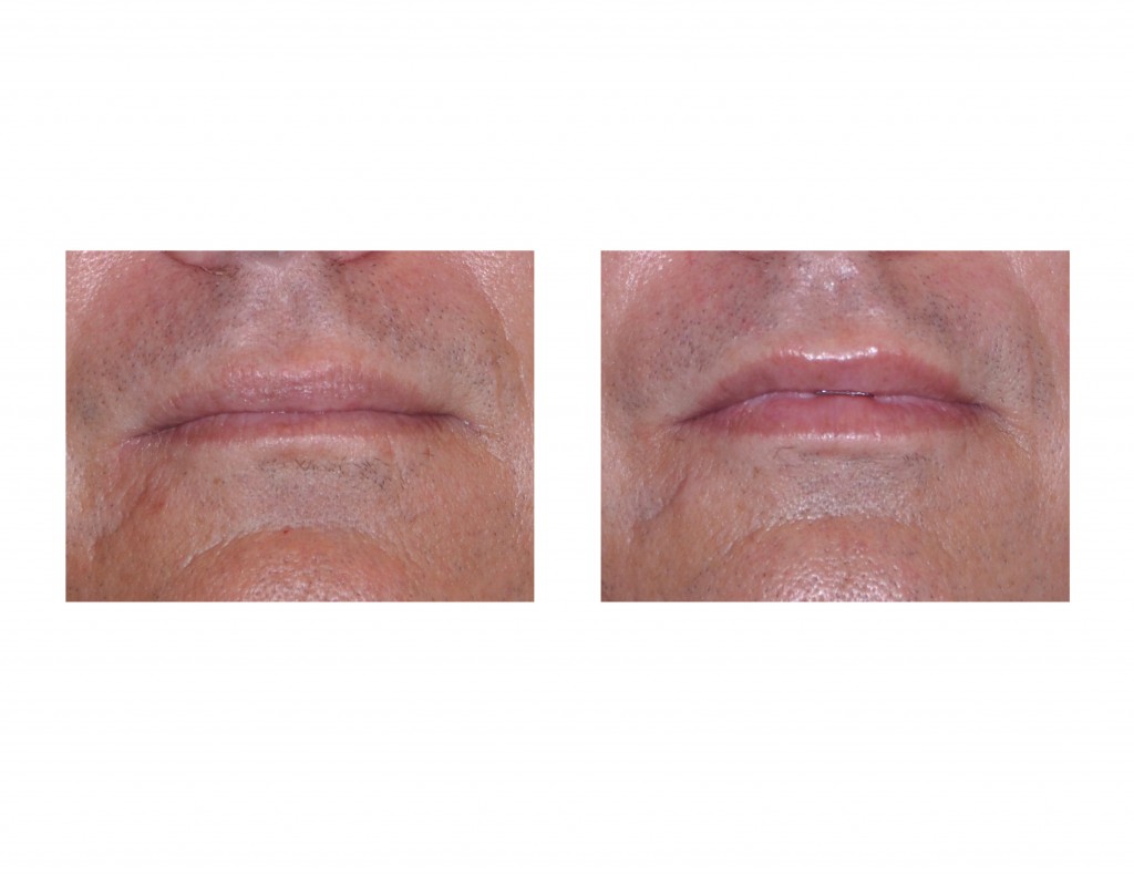 Case Study: Male Lip Implant Augmentation - Explore Plastic Surgery