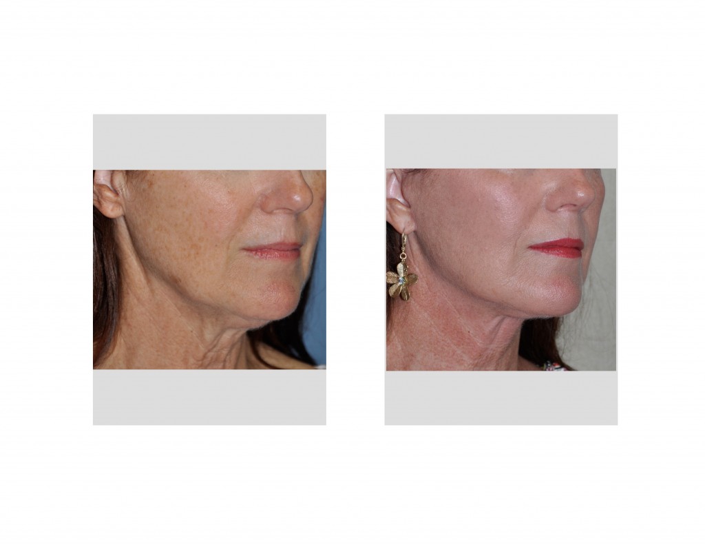 Necklifts for the Younger Patient - Explore Plastic Surgery