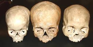 Human Skull Shape Dr Barry Eppley Indianapolis - Explore Plastic Surgery