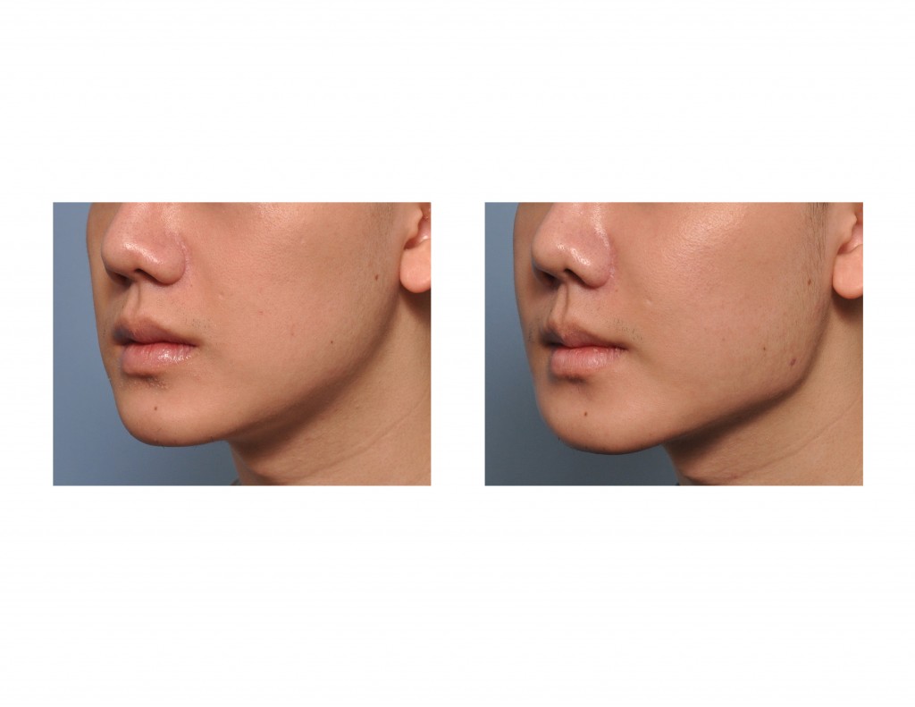 Case Study: Jaw Angle Implants For Complete Jawline Enhancement ...