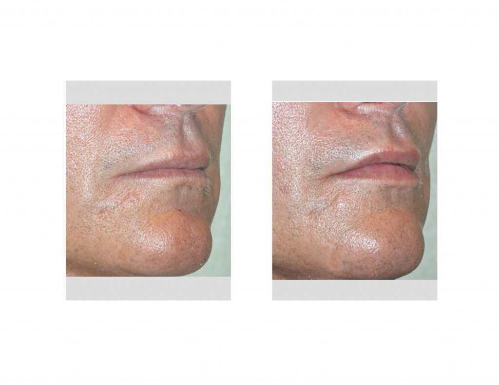 Case Study: Labiomental Fold Reduction with Implant - Explore Plastic ...