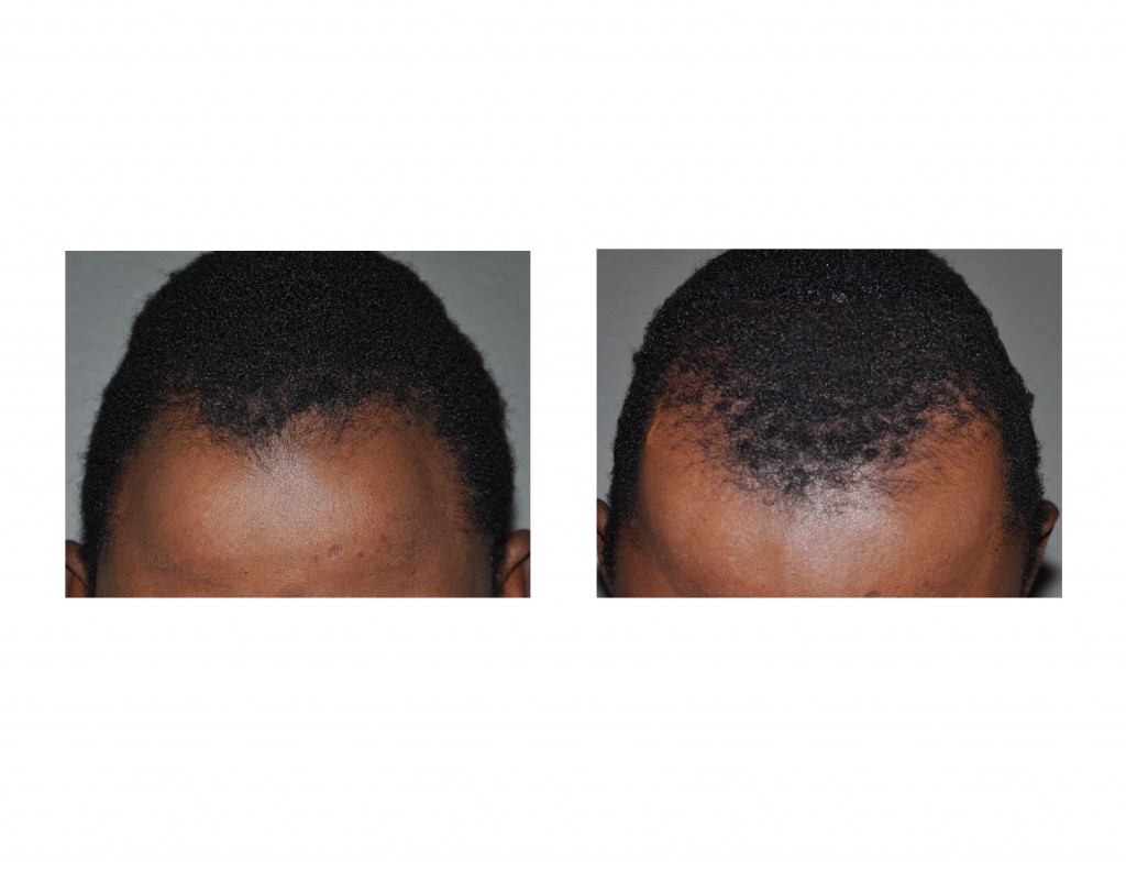 Case Study: Skull Reshaping of the Triangular-Shaped Skull Deformity ...