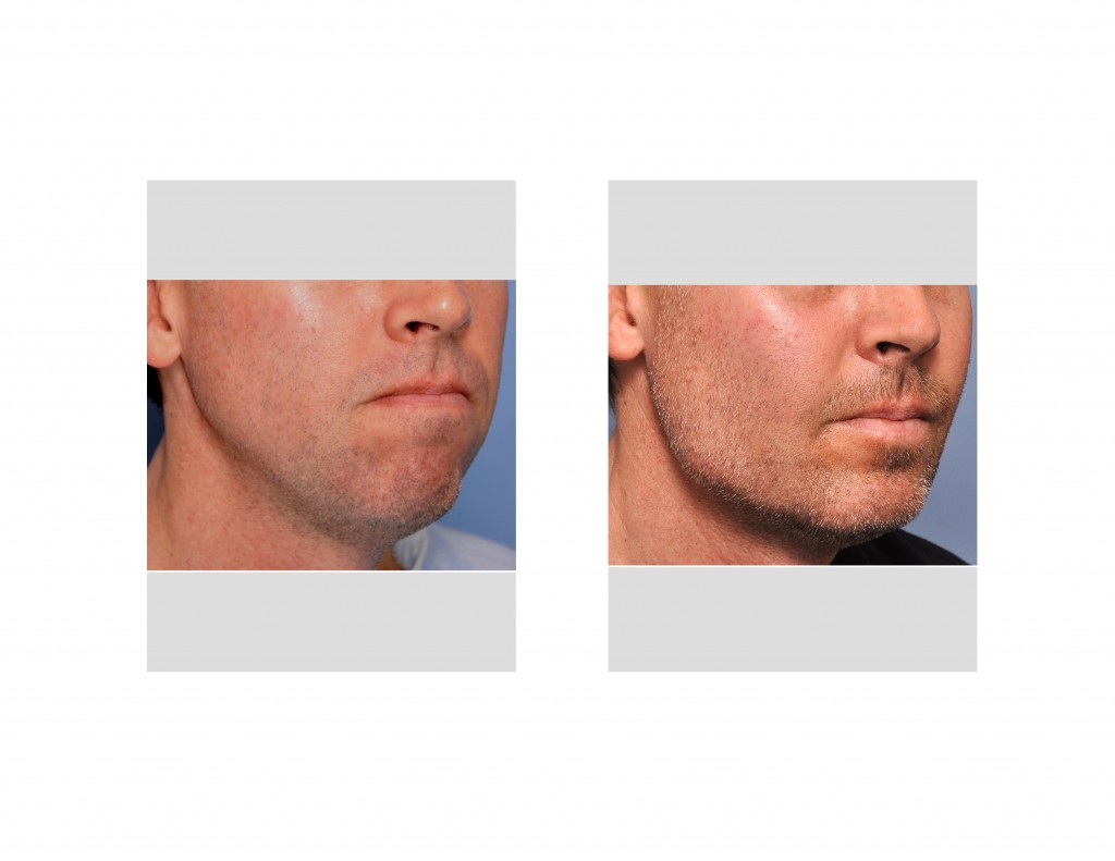 Jaw Angle Augmentation: Matching Implant Styles and Jaw Angle Changes ...