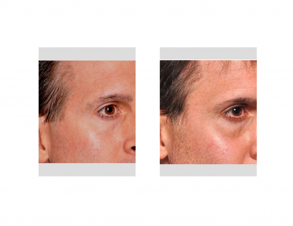 Postoperative Instructions for Temporal Implants - Explore Plastic Surgery