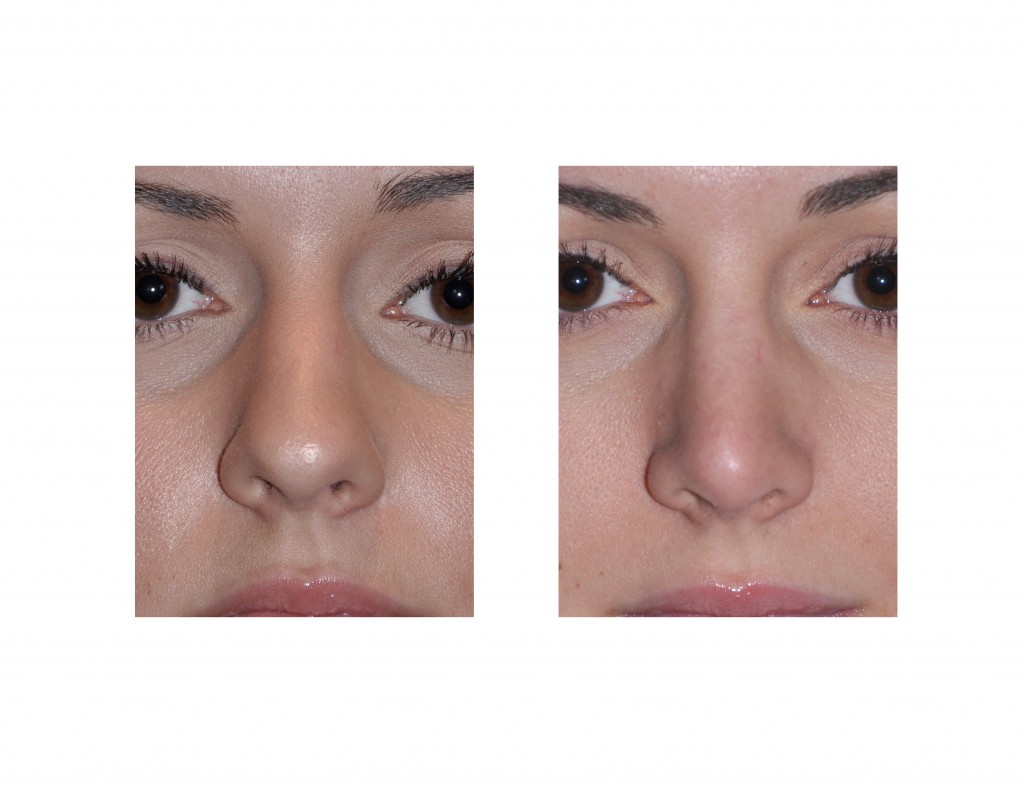 Case Study: Rhinoplasty for the Greek Nose - Explore Plastic Surgery