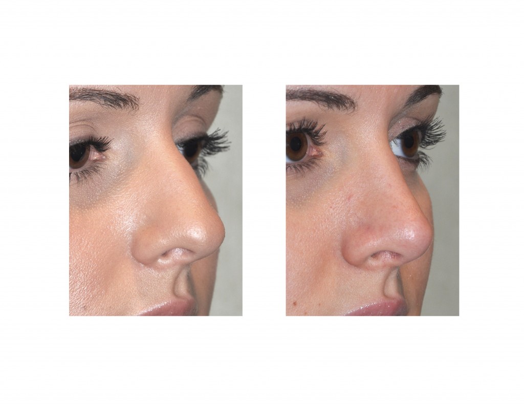 Case Study: Rhinoplasty for the Greek Nose - Explore Plastic Surgery