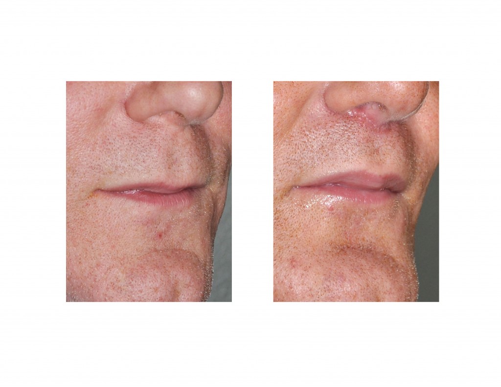 Case Study: The BullHorn Lip Lift in Men - Explore Plastic Surgery