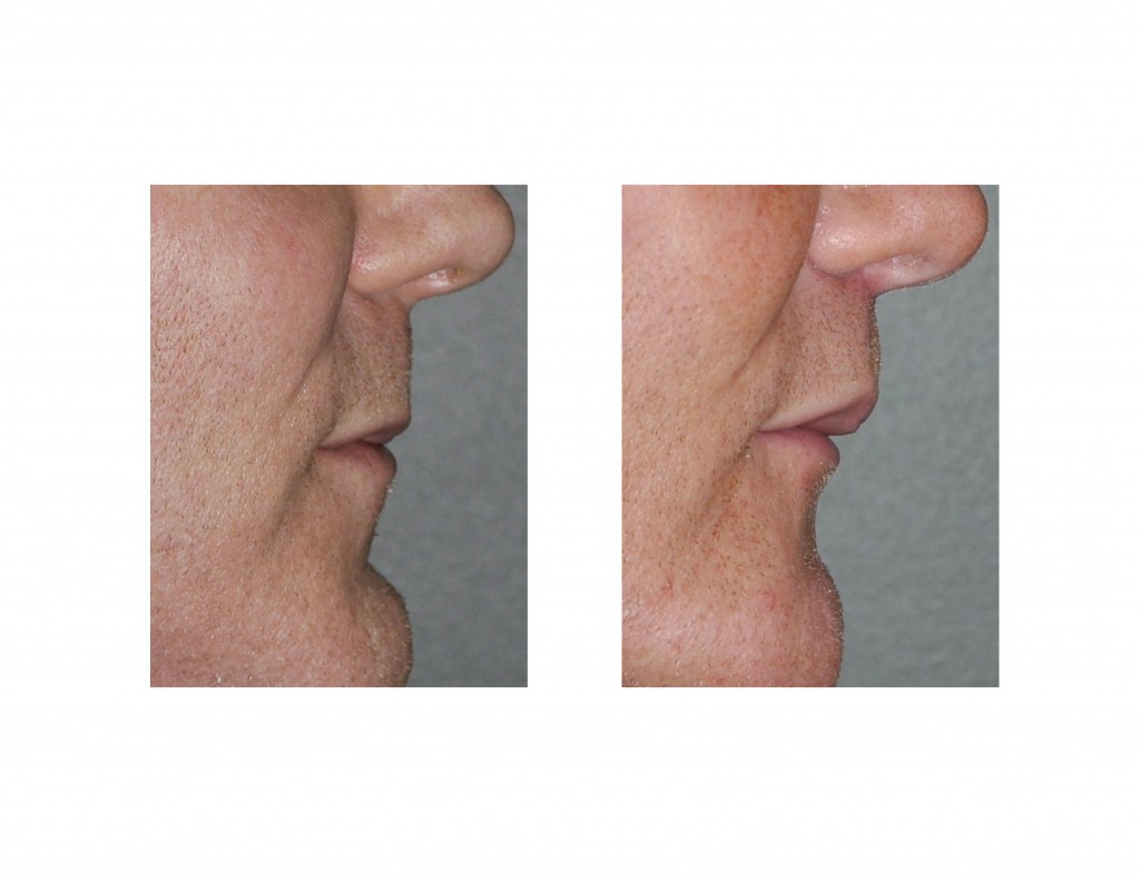Male Lip Lift result Dr Barry Eppley Indianapolis side view - Explore ...