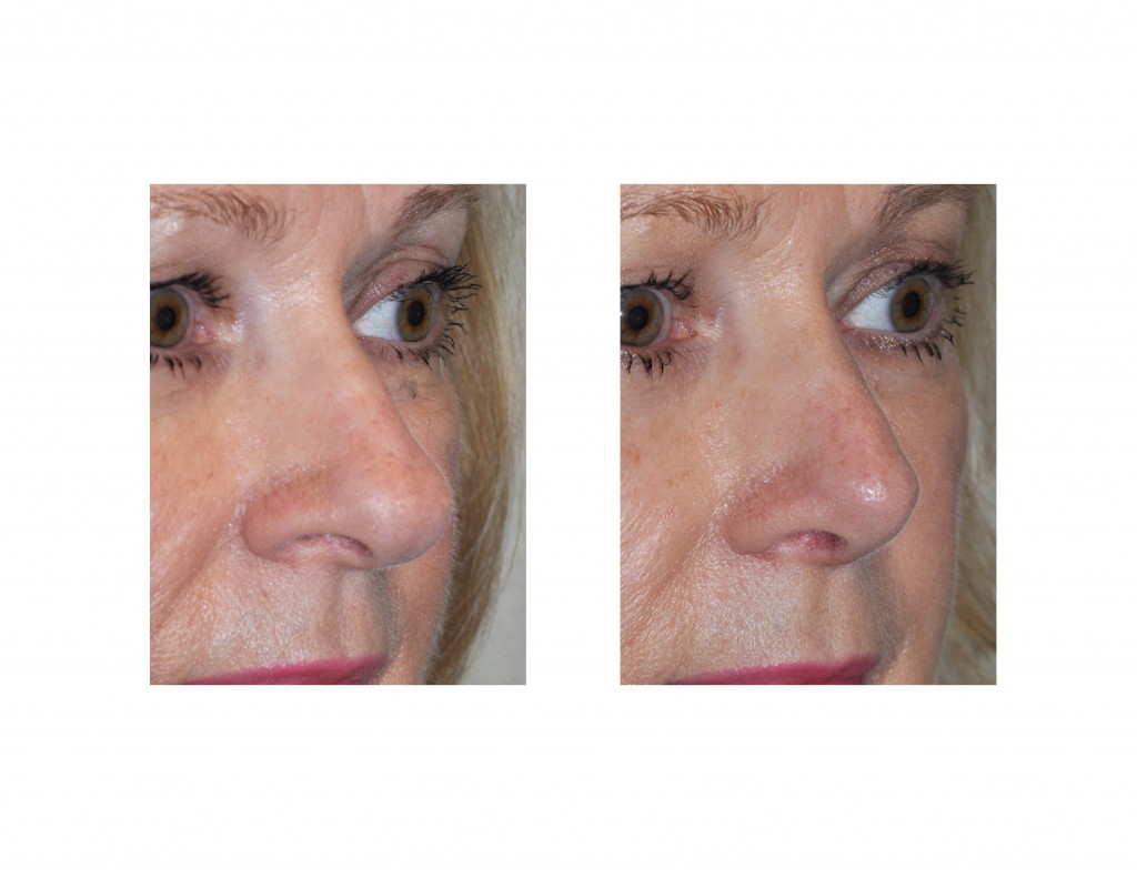 Case Study: Rhinoplasty for the Bigger Older Nose - Explore Plastic Surgery