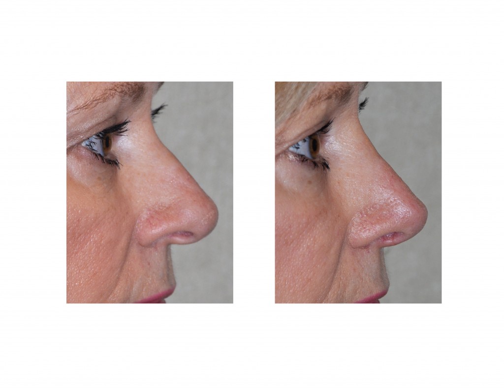 Case Study Rhinoplasty For The Bigger Older Nose Explore Plastic Surgery