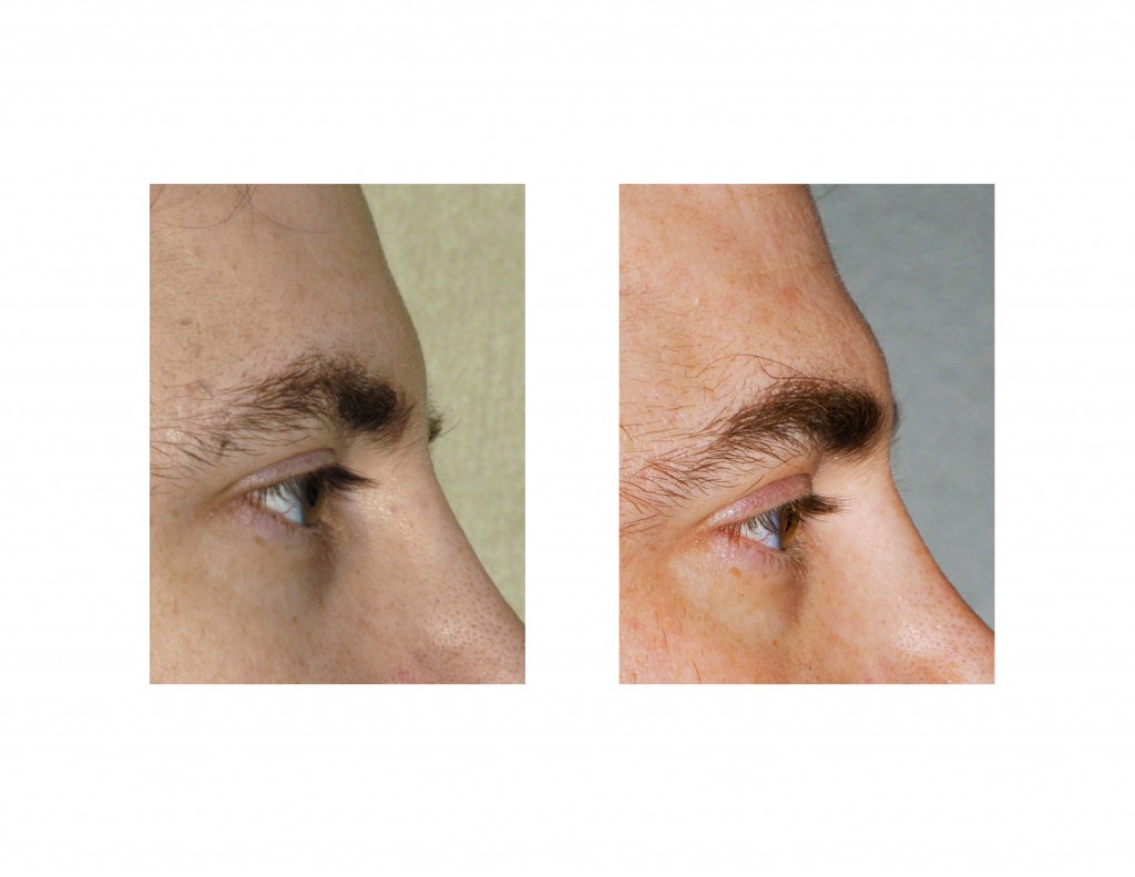 Brow Augmentation by Fat Injections - Explore Plastic Surgery